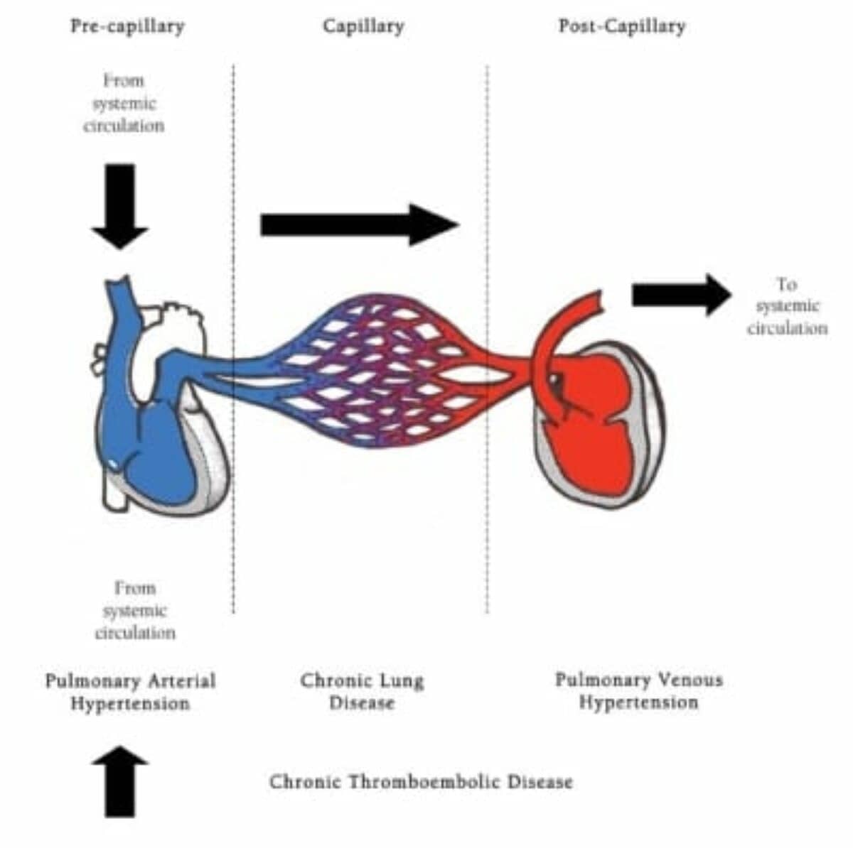What Is Pulmonary Capillary Pressure - Infoupdate.org