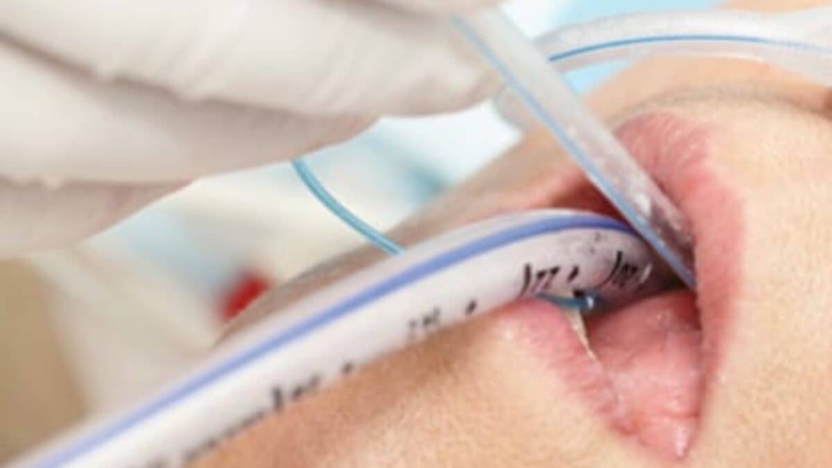 Intubation Ventilation NAEMSP: Endotracheal Intubation And The EMS