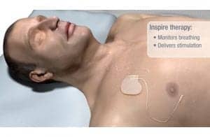 Key Component of Inspire Therapy for Sleep Apnea Recalled | RT