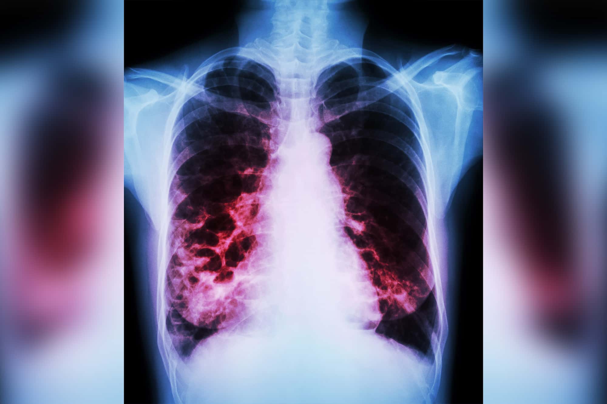 COPD Patients with Bronchiectasis Face Greater Mortality Risk | RT