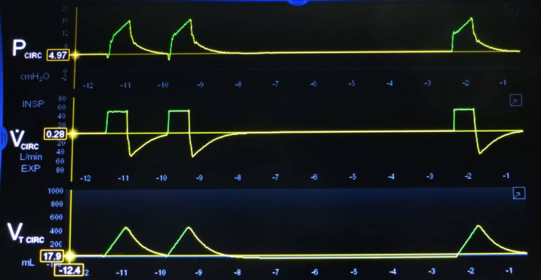 Understanding Ventilator Basics and Ventilator Waveforms | RT