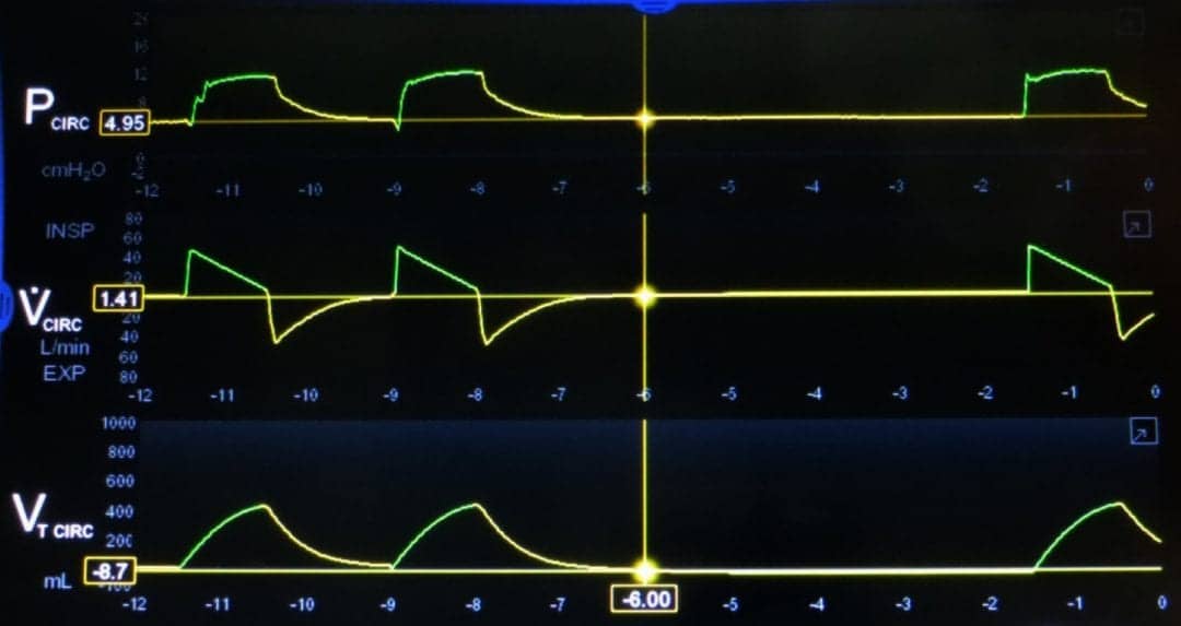 Understanding Ventilator Basics and Ventilator Waveforms | RT