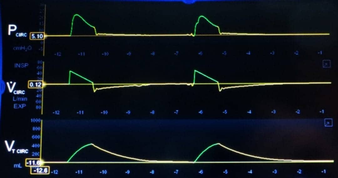 Understanding Ventilator Basics and Ventilator Waveforms | RT