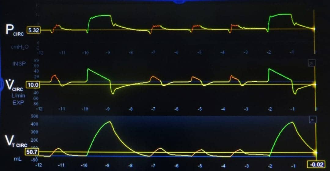 Understanding Ventilator Basics and Ventilator Waveforms | RT
