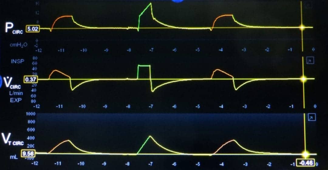Understanding Ventilator Basics and Ventilator Waveforms | RT