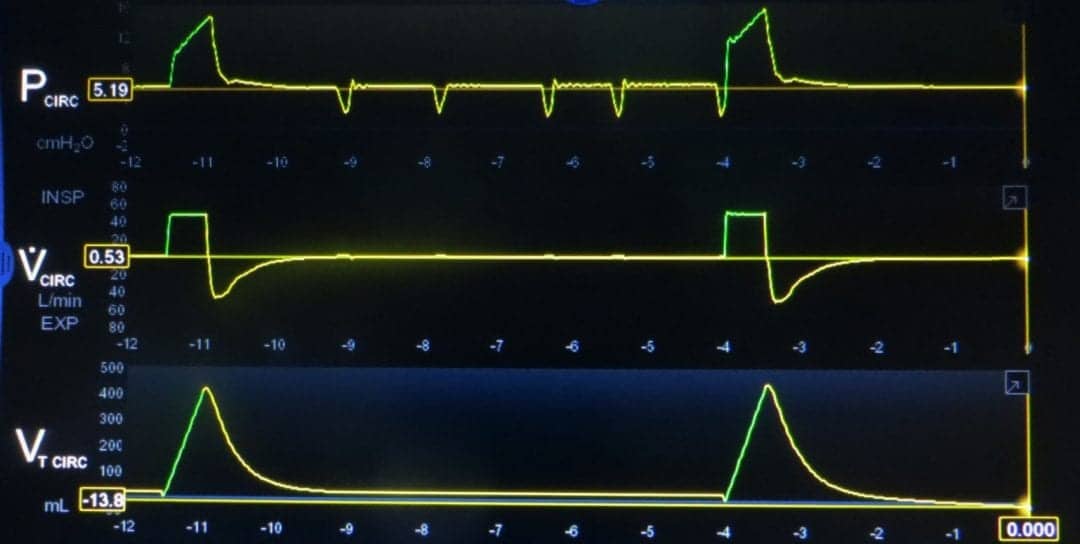Understanding Ventilator Basics and Ventilator Waveforms | RT