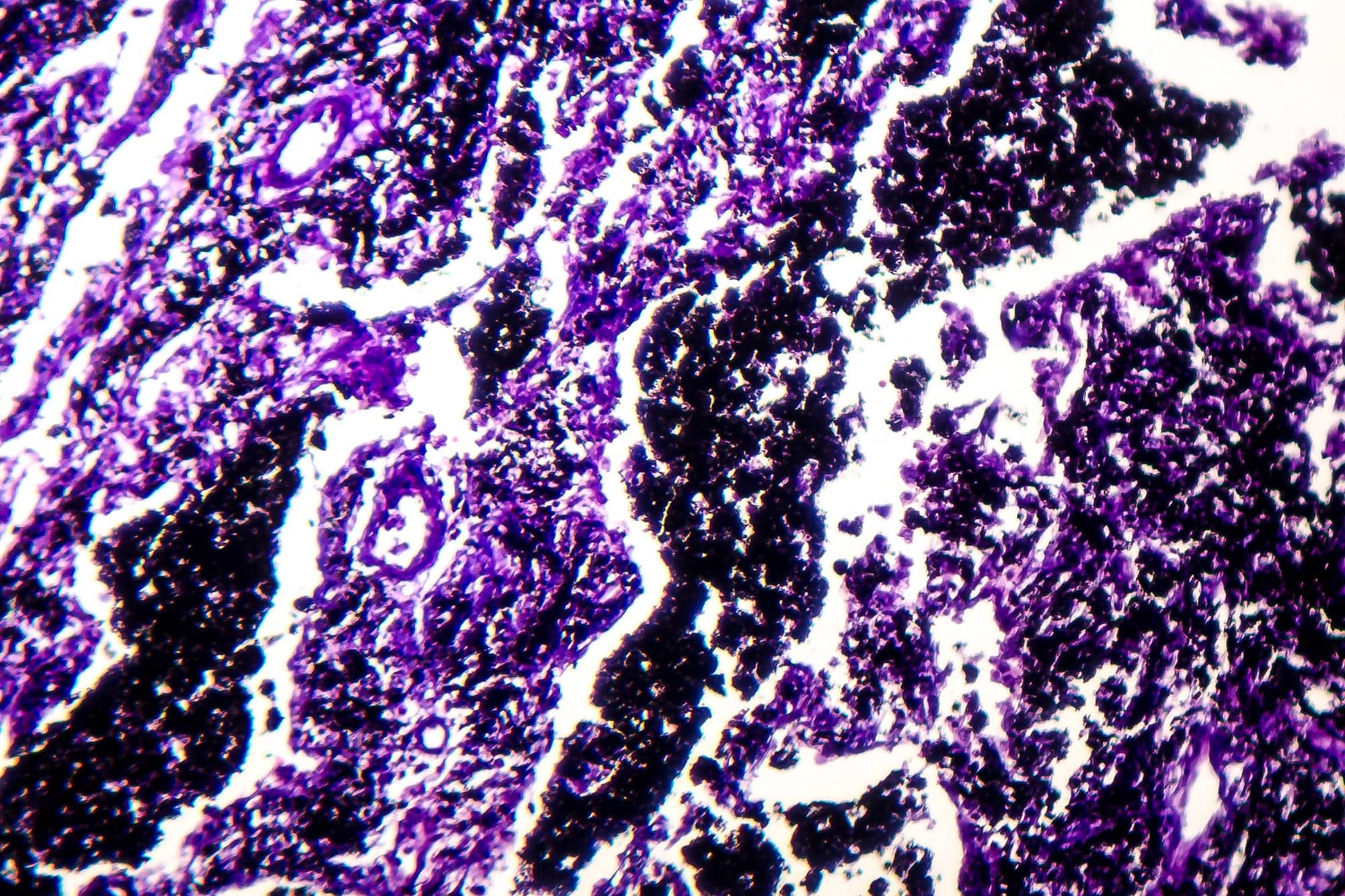 Pulmonary Fibrosis and Idiopathic Pulmonary Fibrosis | RT