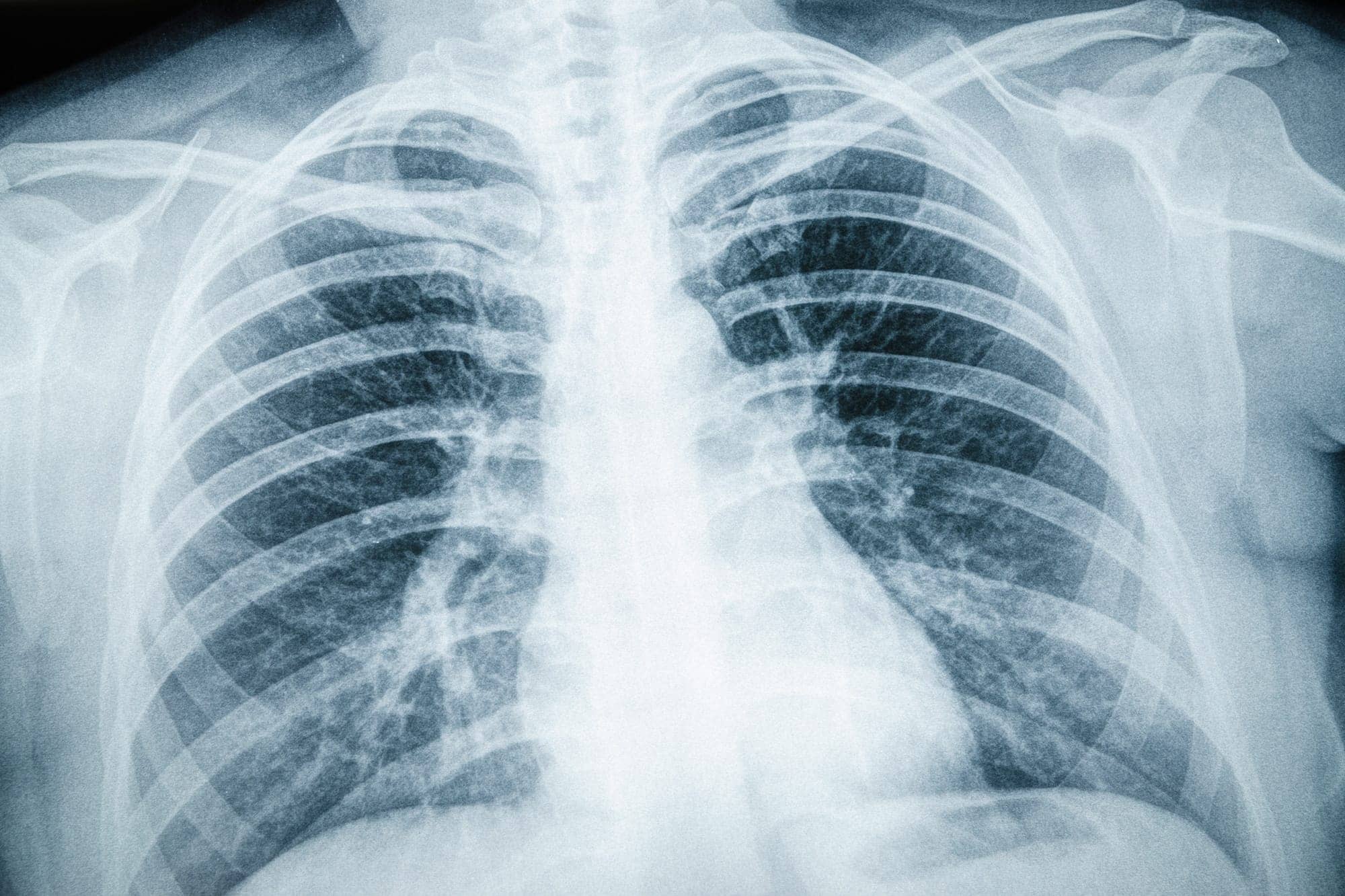 How To Read A Chest Xray Ii Pneumonia Medchrome Images Of Aspiration