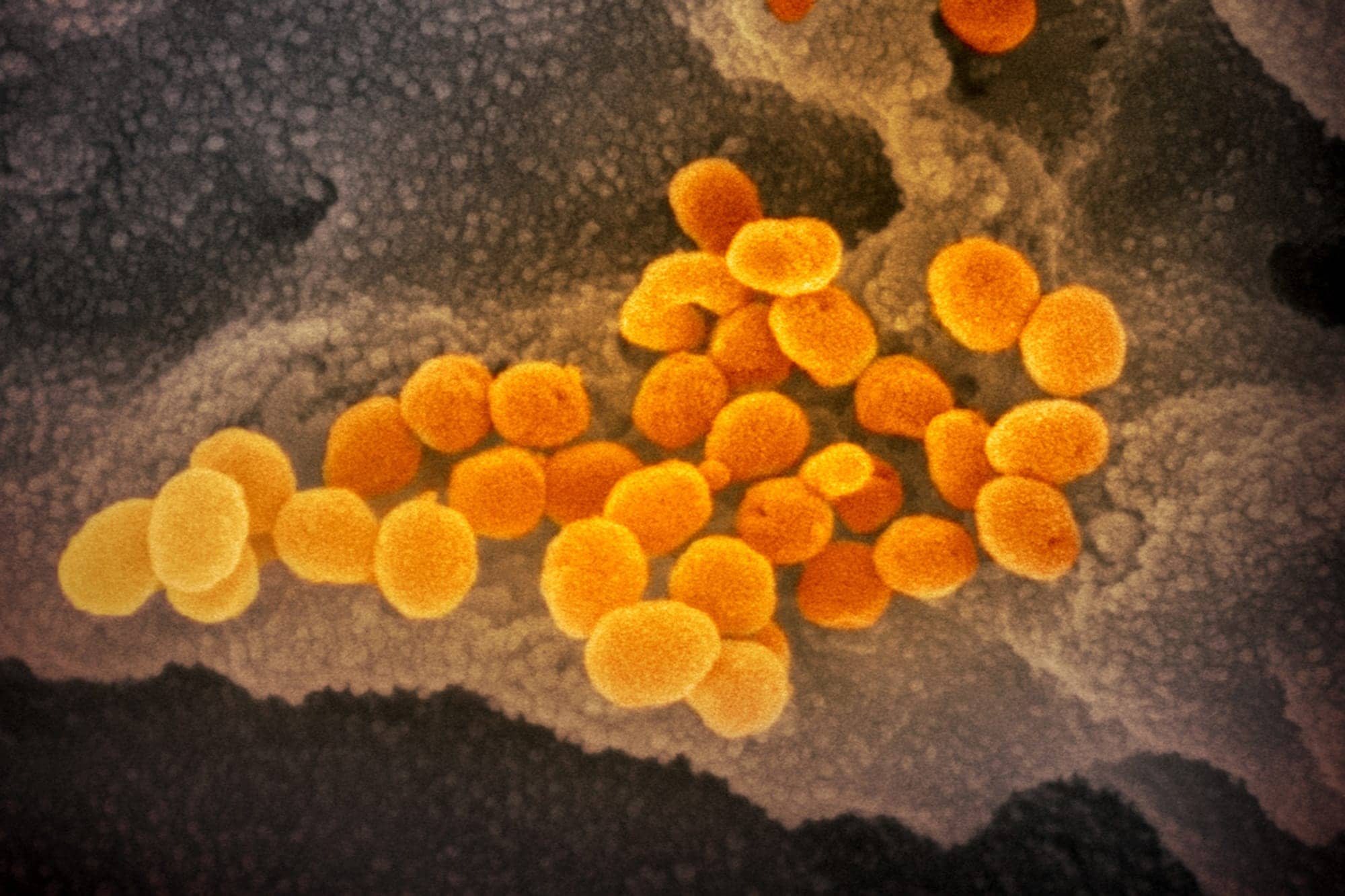 Evidence that COVID-19 May Trigger Diabetes in Some Patients ...
