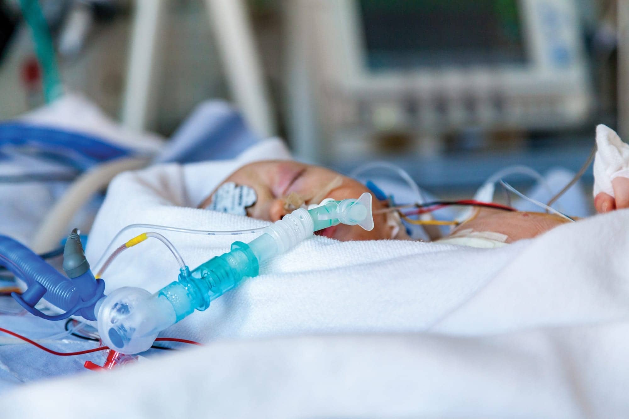 Preventing Unplanned Extubations in the NICU/PICU | RT