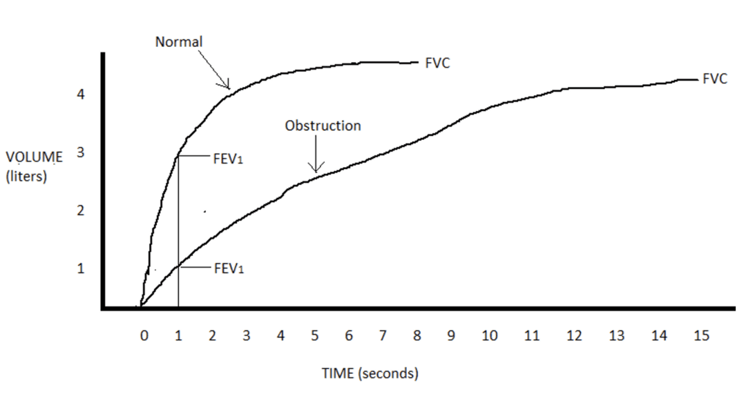 Top 5 Spirometry Tips for COPD Diagnosis and Management | Respiratory ...
