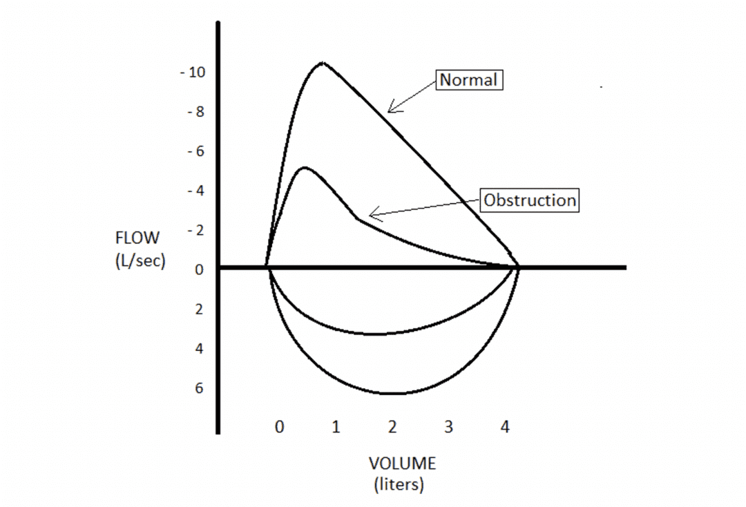 Top 5 Spirometry Tips for COPD Diagnosis and Management | Respiratory ...
