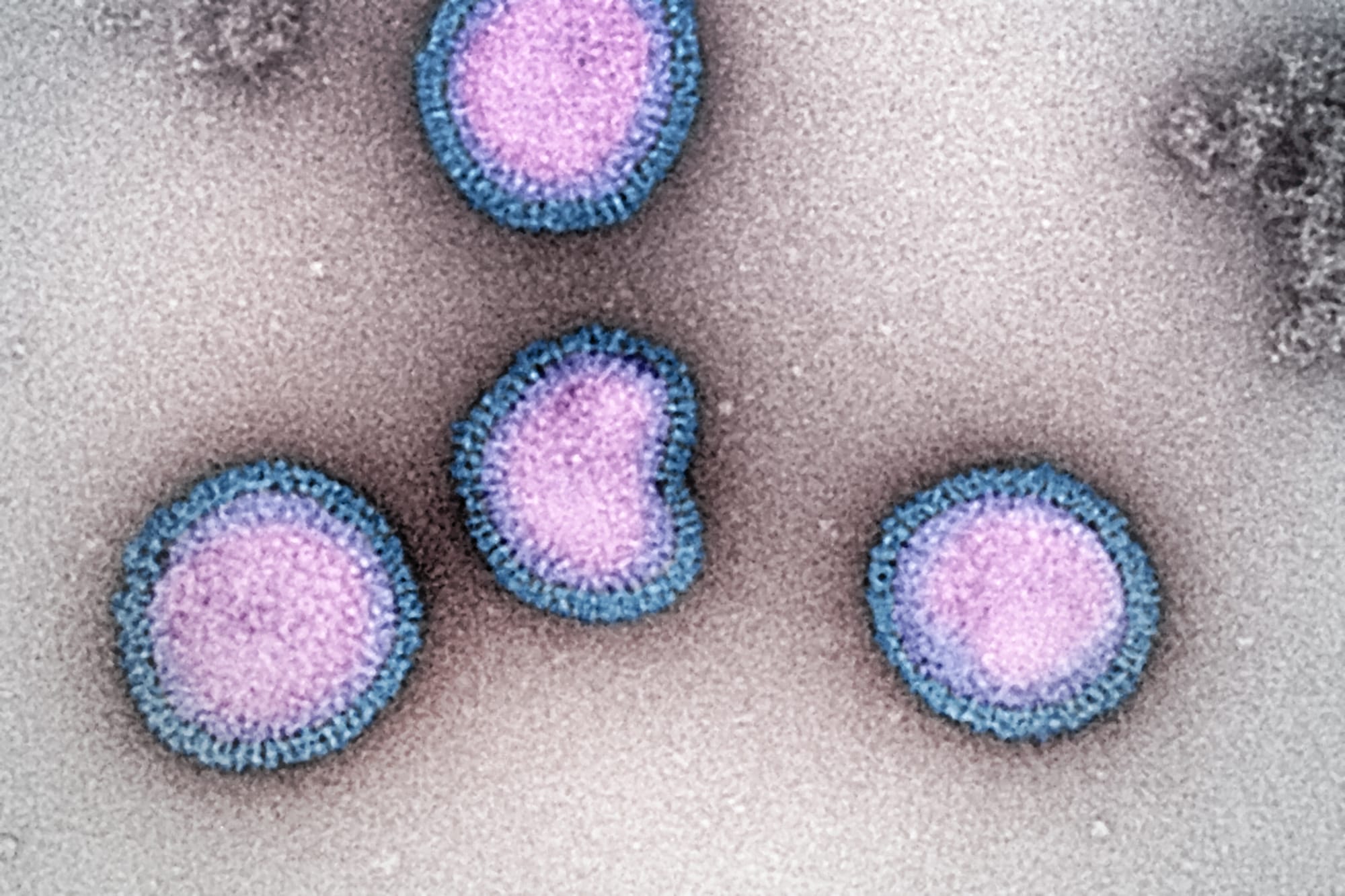 CDC: 2nd Human Case of Avian Flu Tied to Dairy Cow Outbreak