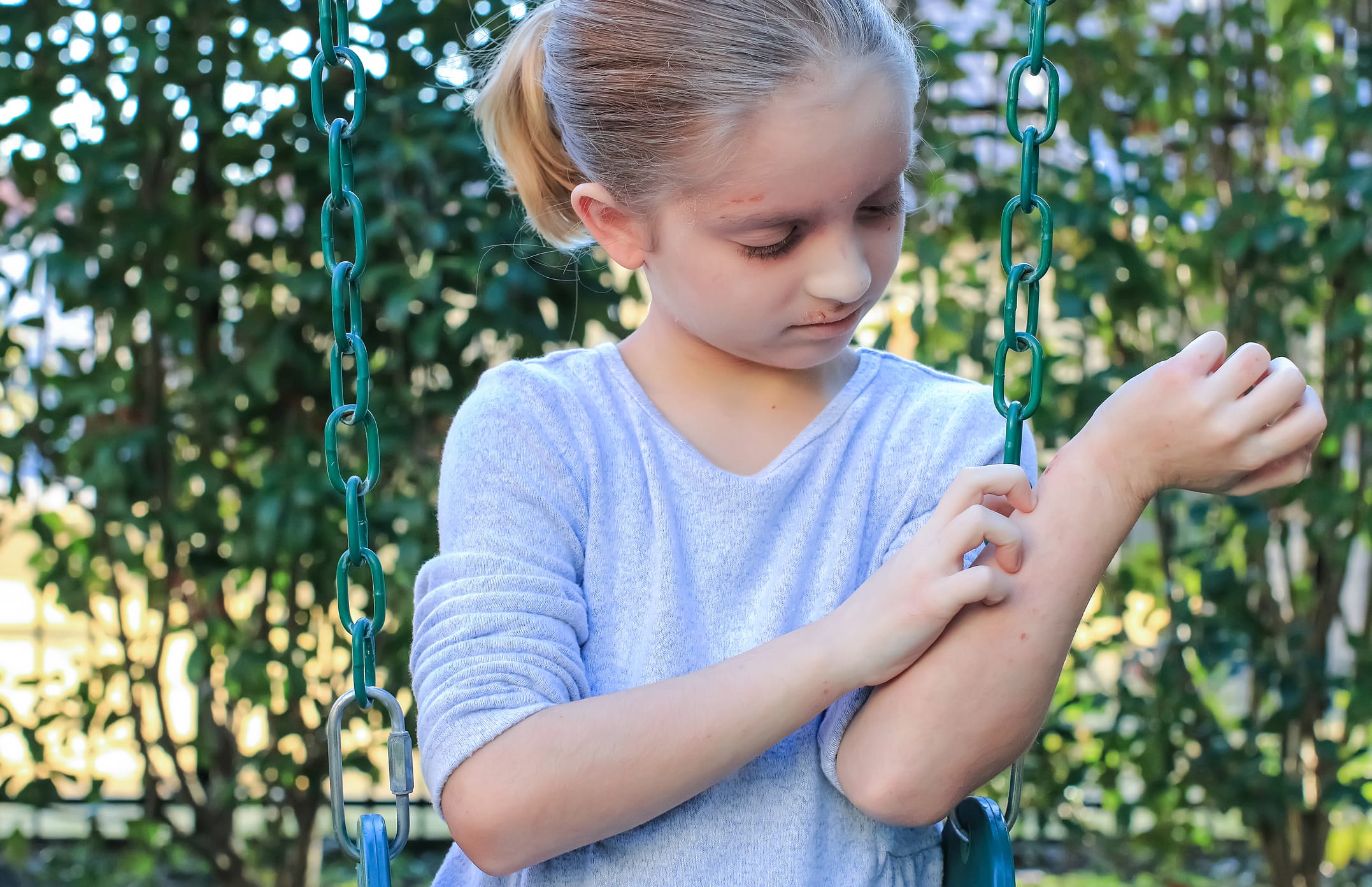 ‘Allergic March’ Validated in New Pediatric Allergy Research ...
