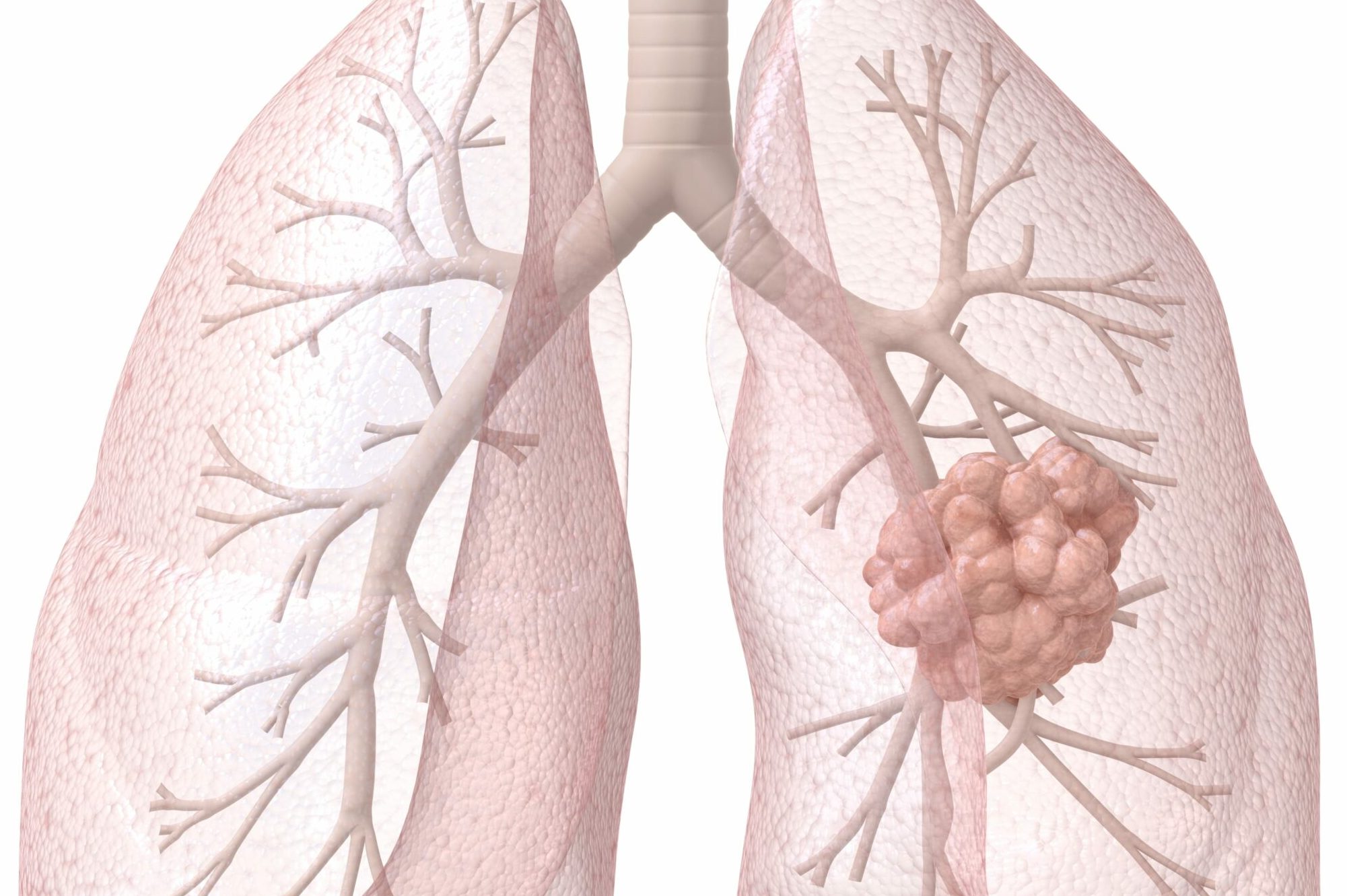 FDA Approves AstraZeneca's Lung Cancer Drugs | RT