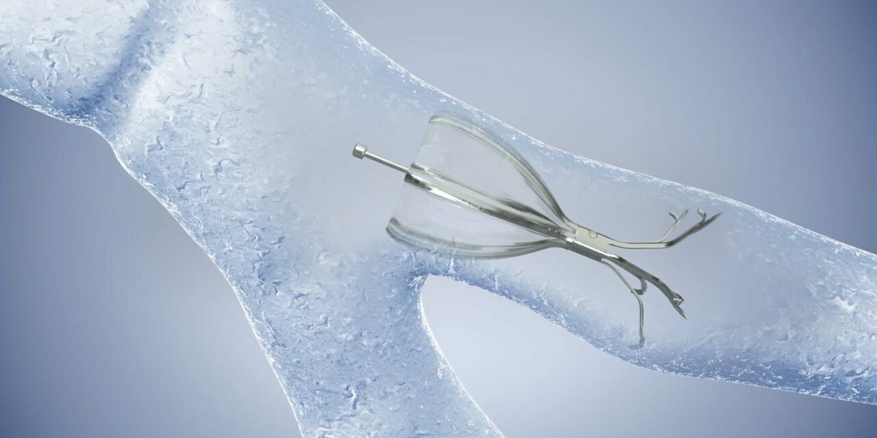 Valve System Shows Sustained Gains in Severe Emphysema | Respiratory ...