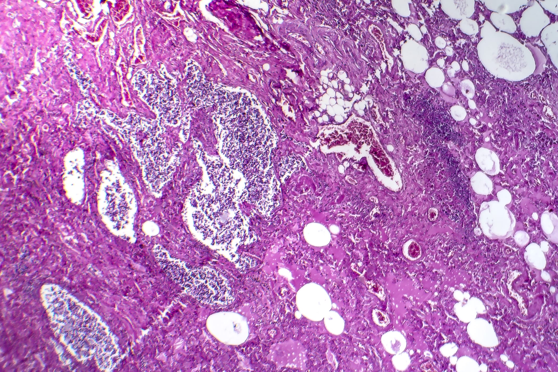 Promising Antibody-Drug Conjugate for Small Cell Lung Cancer ...
