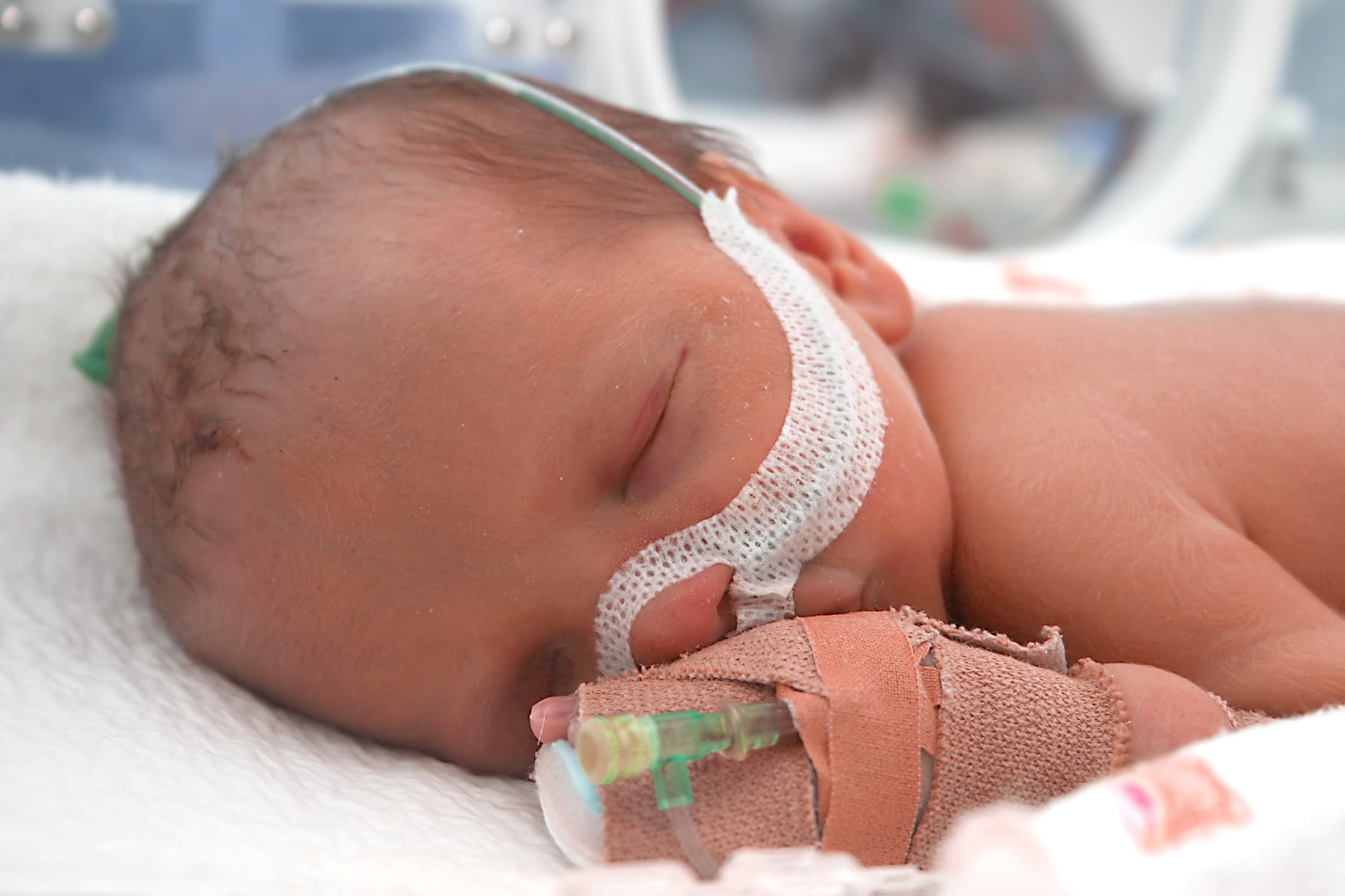 AI Identifies Bronchopulmonary Dysplasia in Premature Infants ...