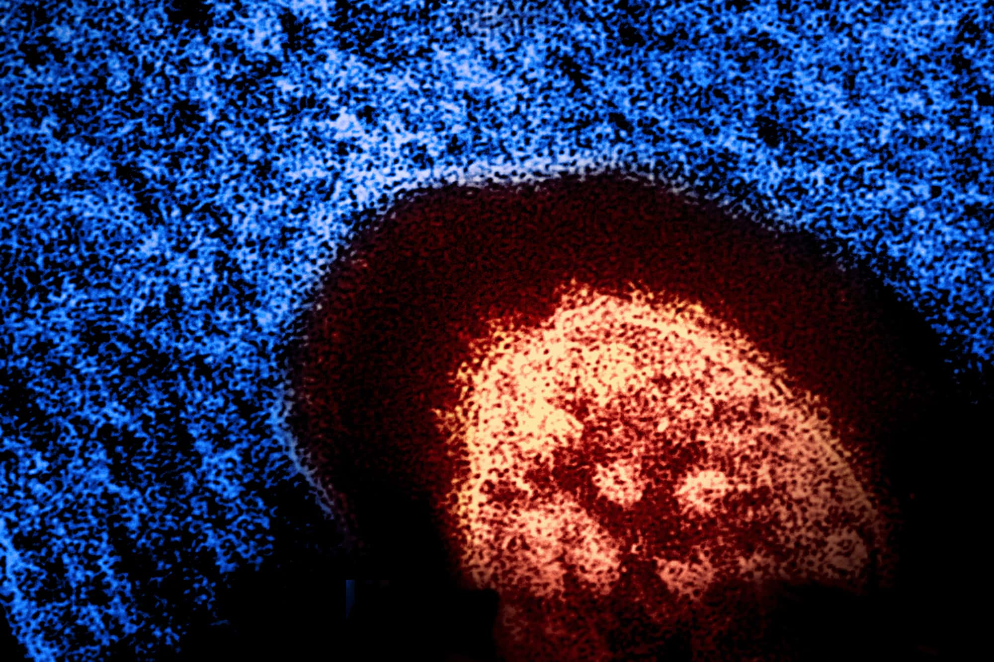 2025 Saw the Most Measles Cases in 34 Years | RT