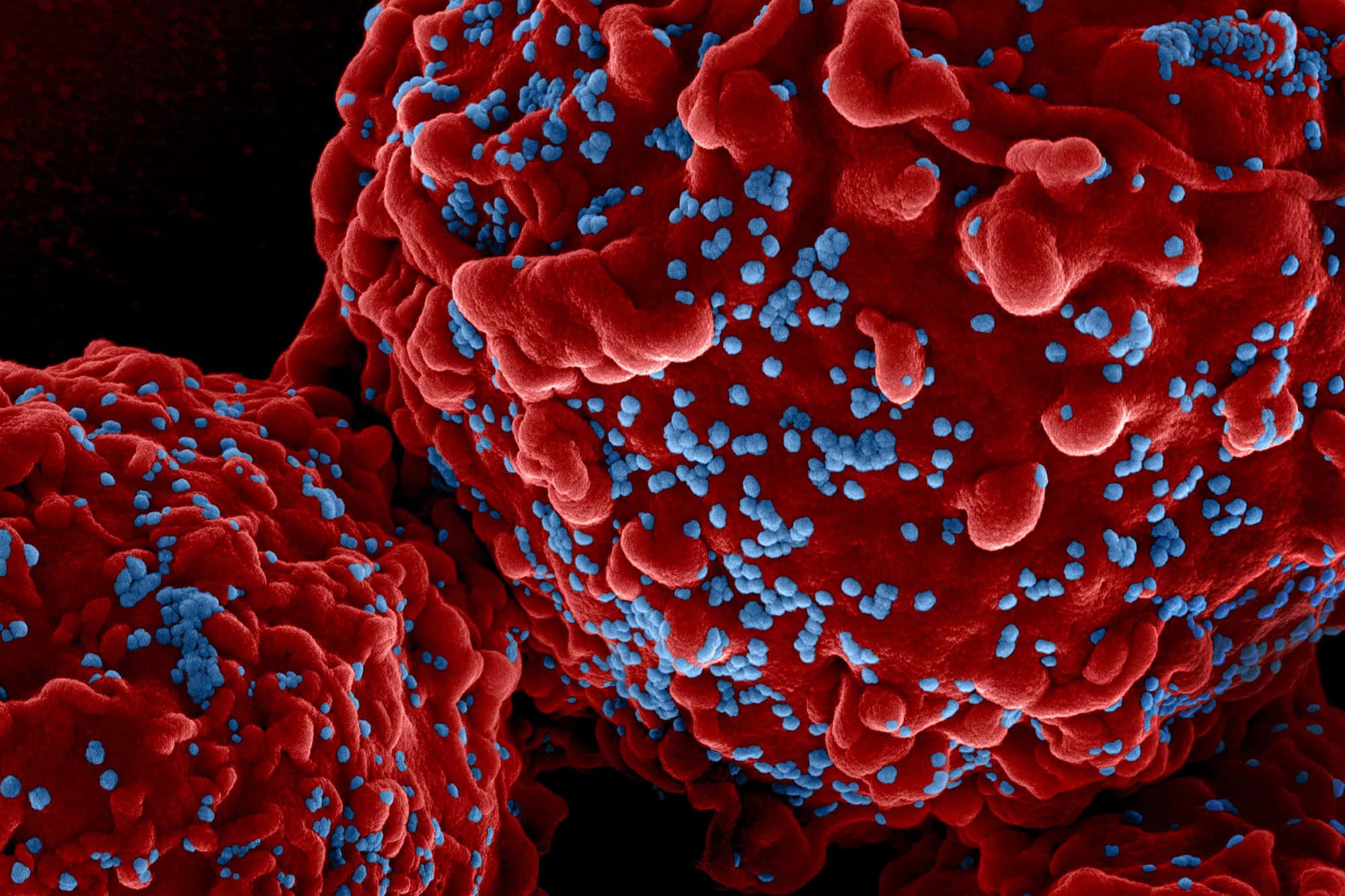 Lung Transplantation in Patients with HIV | RT