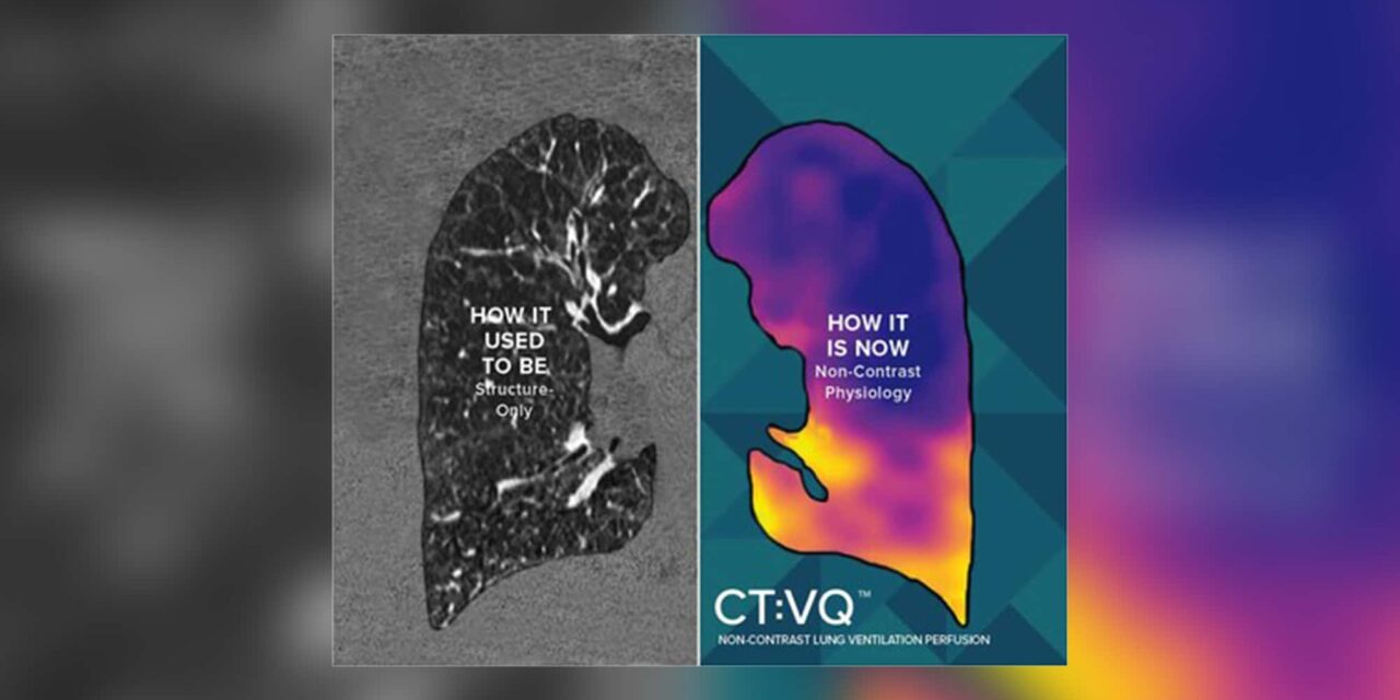FDA Clears CT-VQ Ventilation–Perfusion Imaging | RT