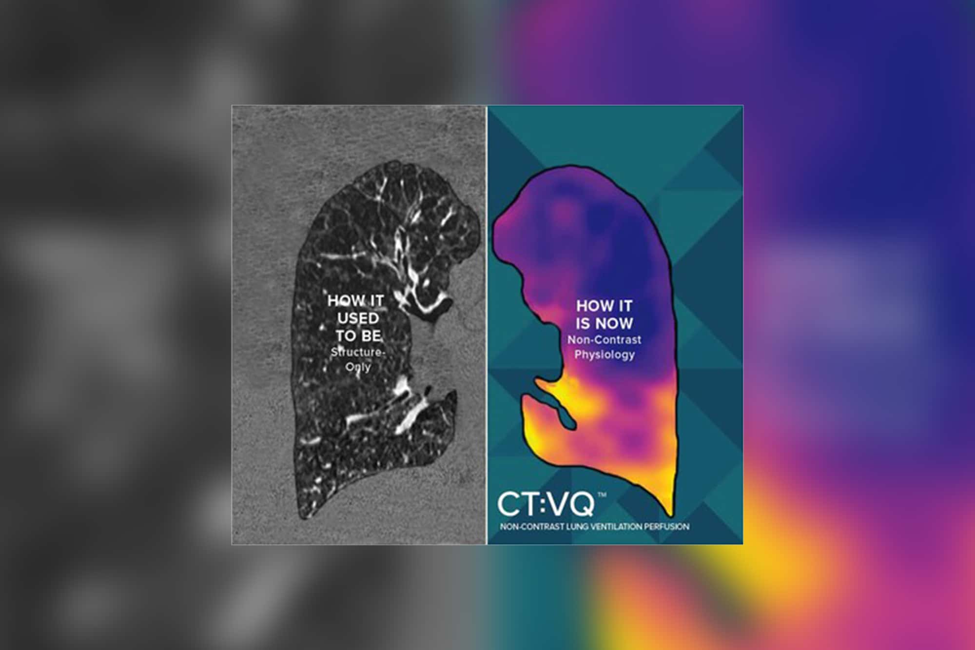 FDA Clears CT-VQ Ventilation–Perfusion Imaging | RT